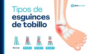 Esguince de Tobillo: Síntomas, Tipos y Tratamiento