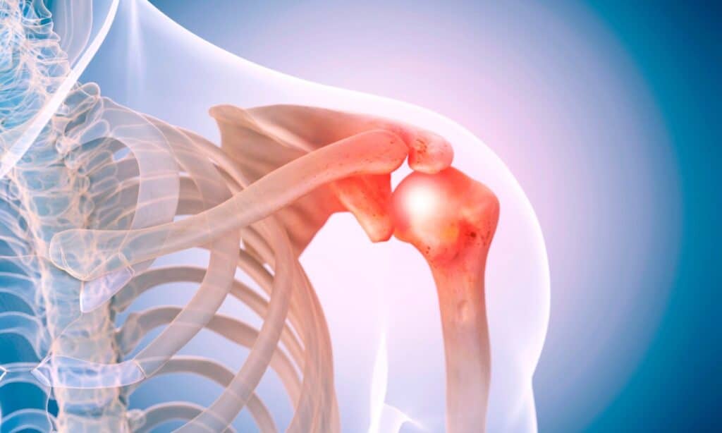 Hombro Congelado: Qué es, Causas y Tratamiento Fisioterapia